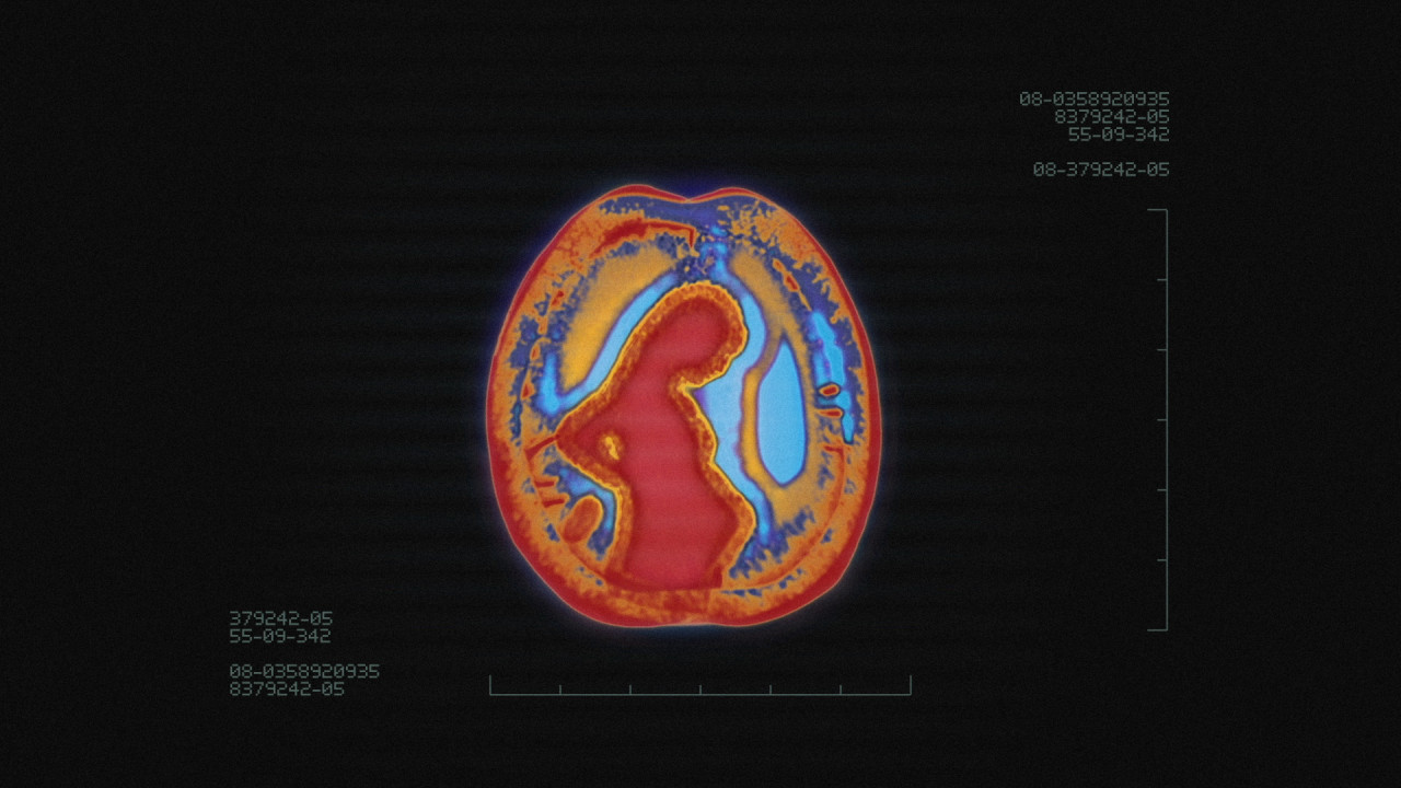 alzheimers_brainscan_image02 - Hatch Studios